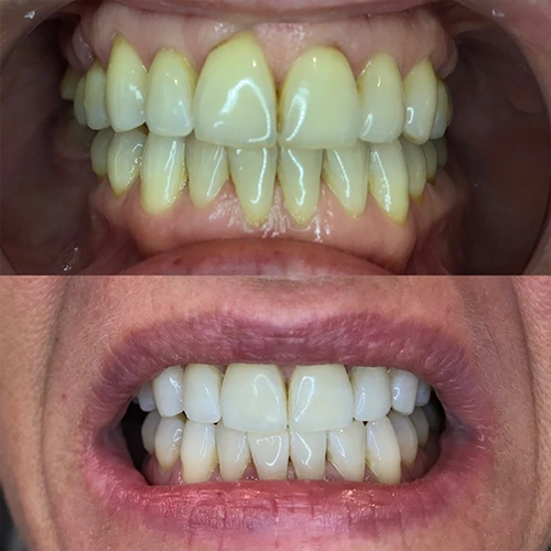 Bright Whites – Smile with Confidence!